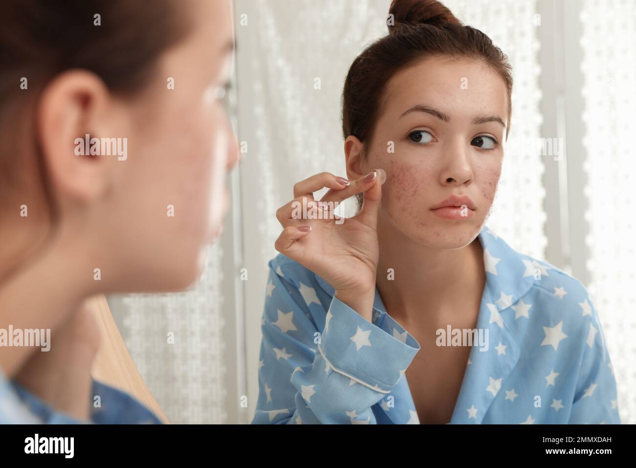 Teen girl problem skin in hi-res stock photography and images - Alamy