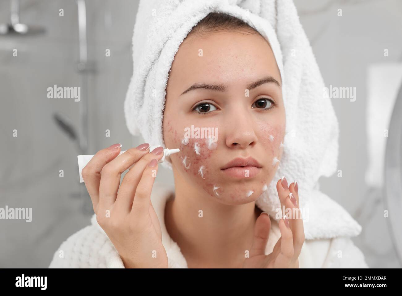 Teen pimple acne cream hi-res stock photography and images - Alamy