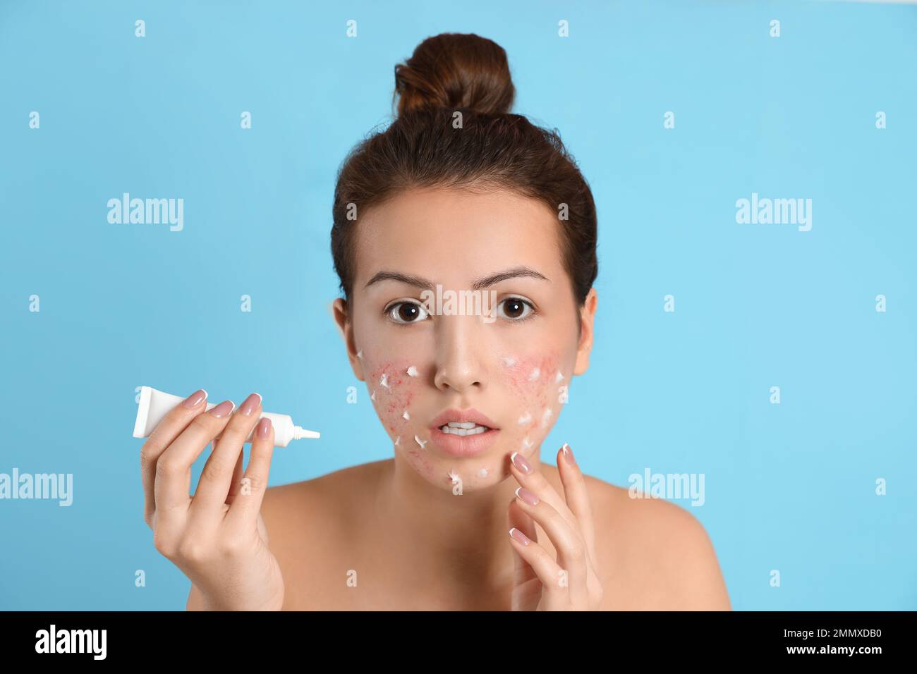 Teen girl with acne problem applying cream on light blue background ...