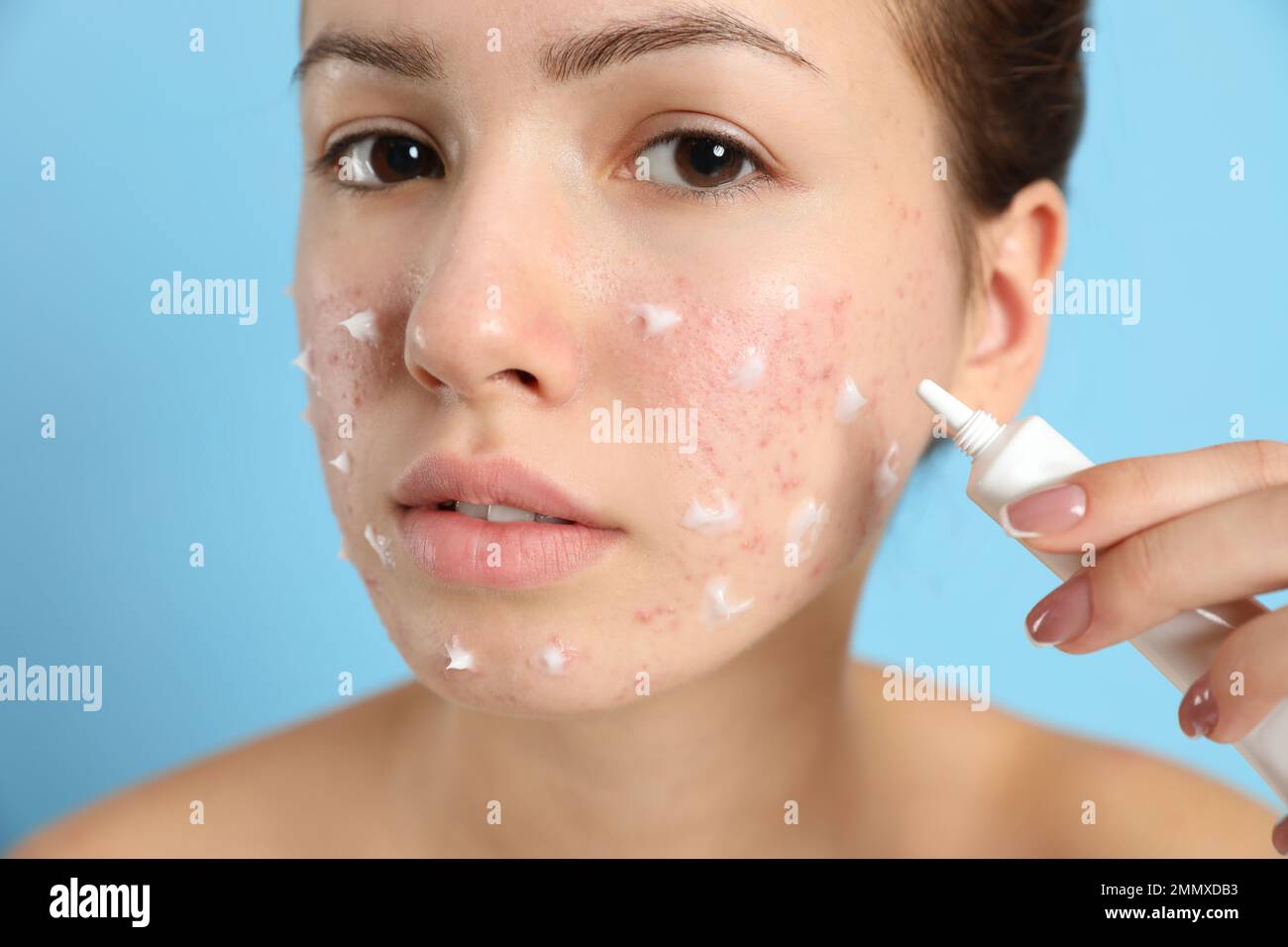 Teen girl with acne problem applying cream on light blue background ...
