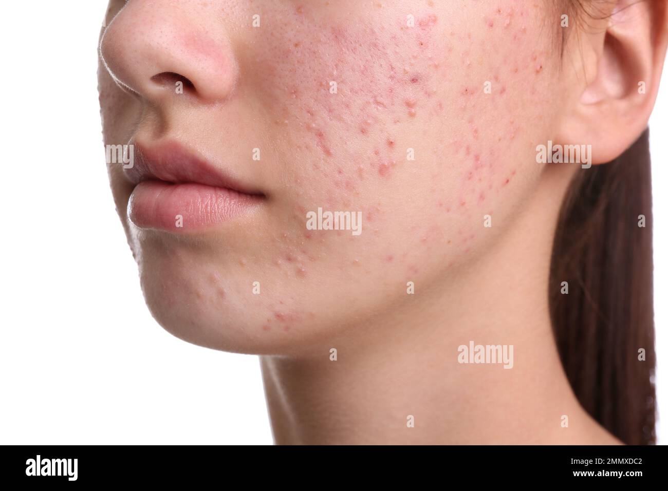 Teenage girl with acne problem on white background, closeup Stock Photo ...