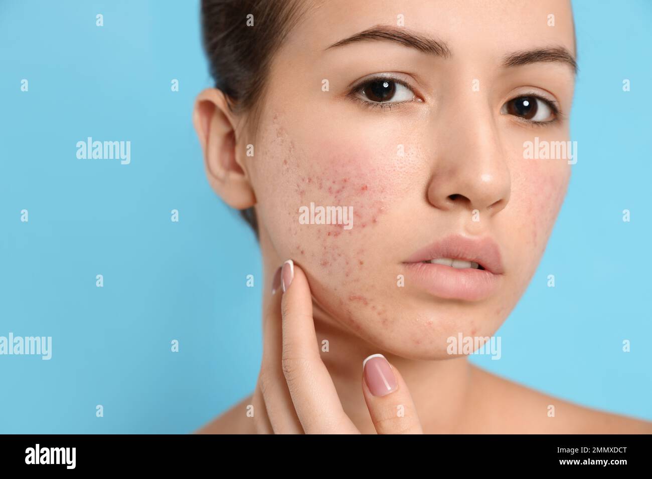 Girl acne problem on hi-res stock photography and images - Alamy