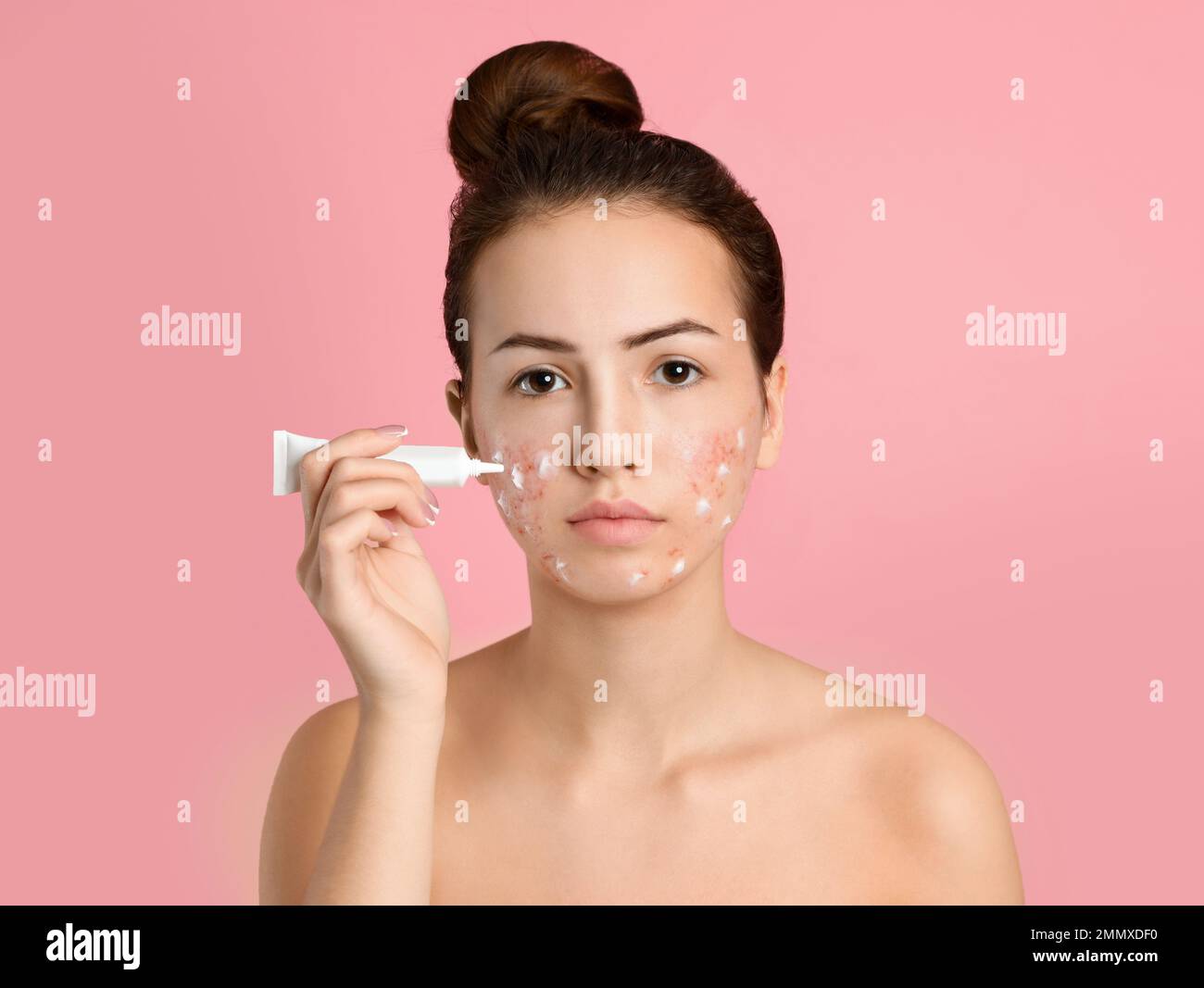 Teen girl with acne problem applying cream on light pink background ...