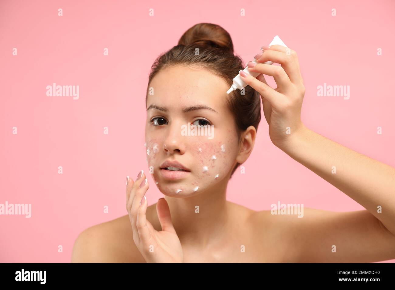 Teen girl with acne problem applying cream on light pink background ...