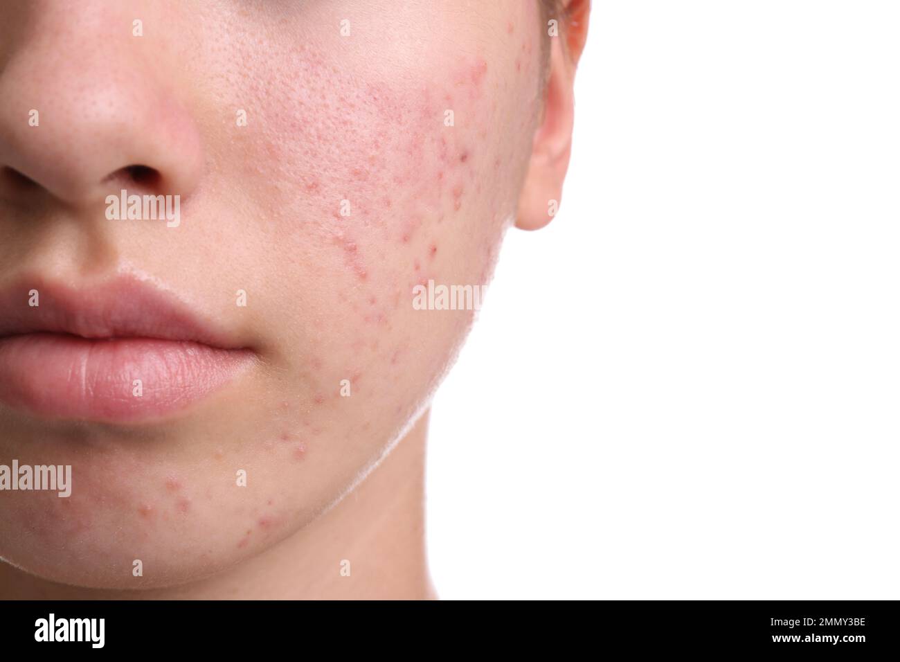 Teenage girl with acne problem on white background, closeup Stock Photo ...