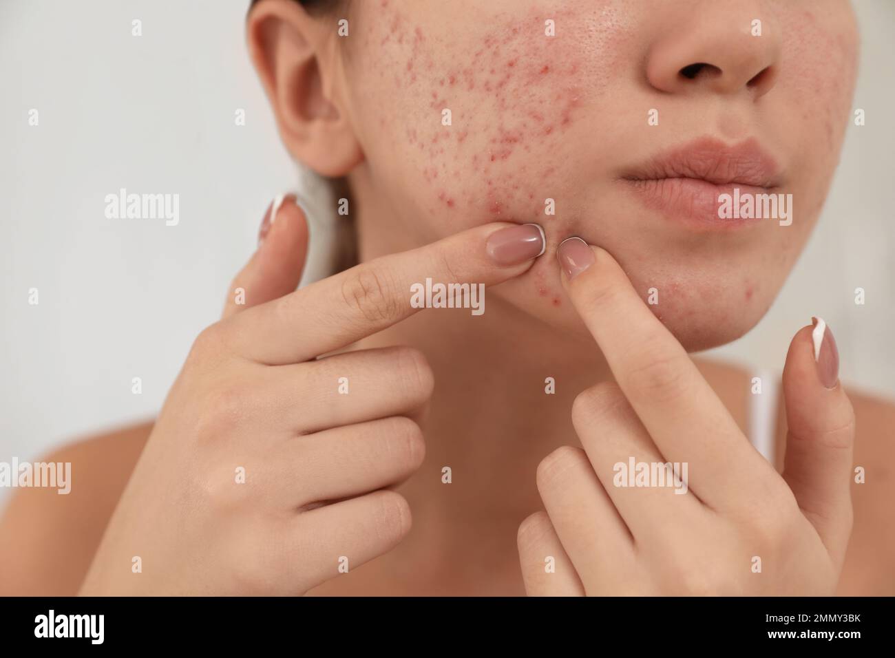 Teen girl with acne problem squeezing pimple on her face, closeup Stock ...
