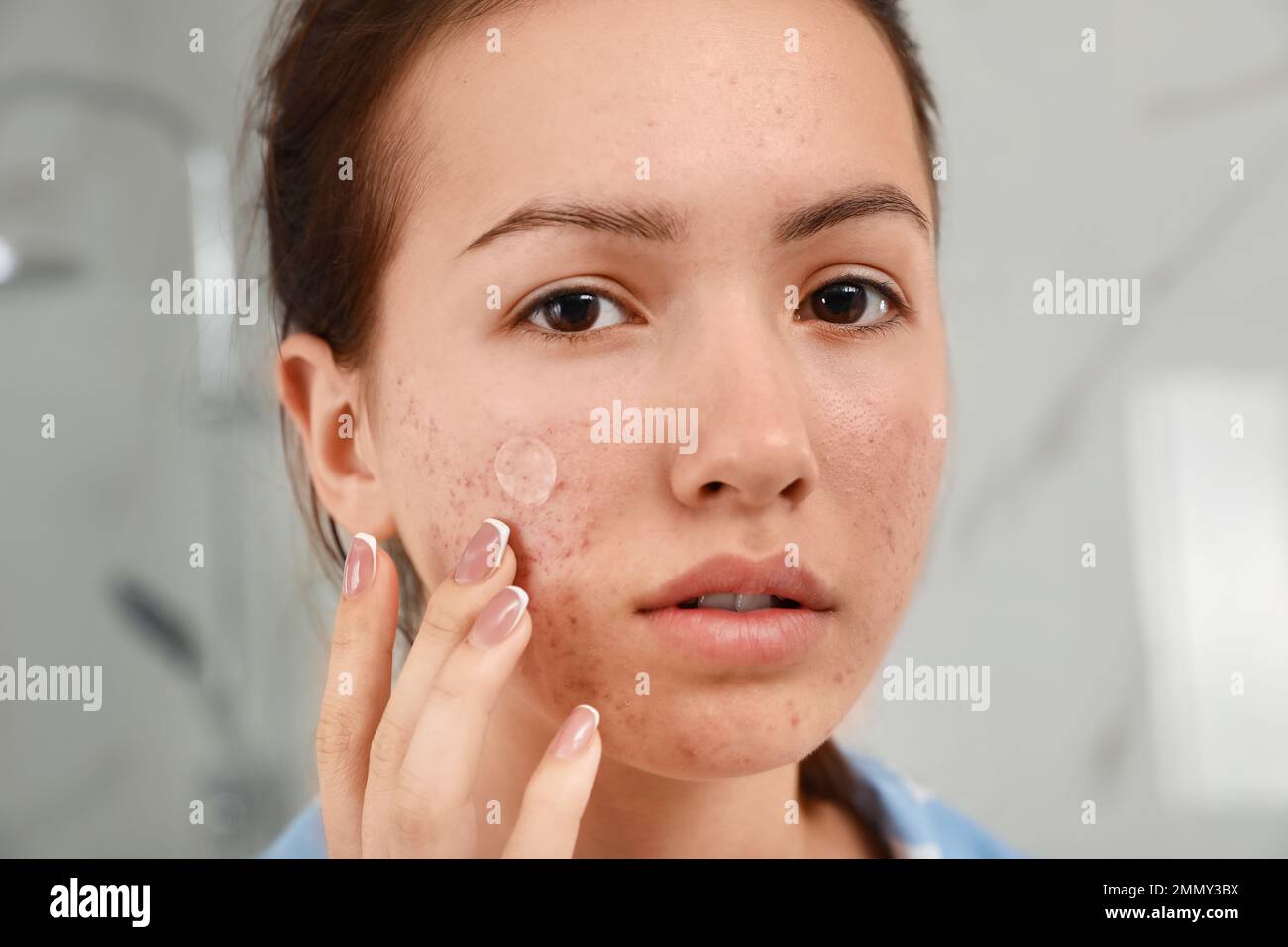 Acne patch hi-res stock photography and images - Alamy