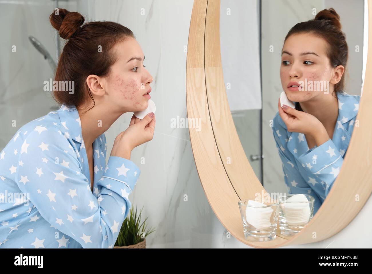 Teen girl with acne problem cleaning her face near mirror in bathroom ...