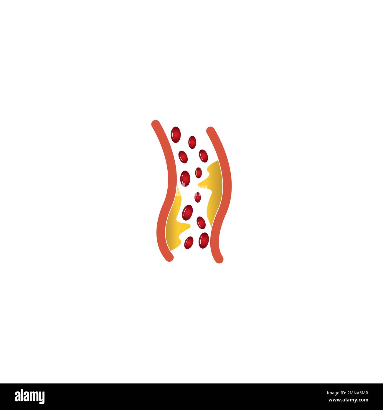 vector of cholesterol plaque illustratrion design Stock Photo - Alamy