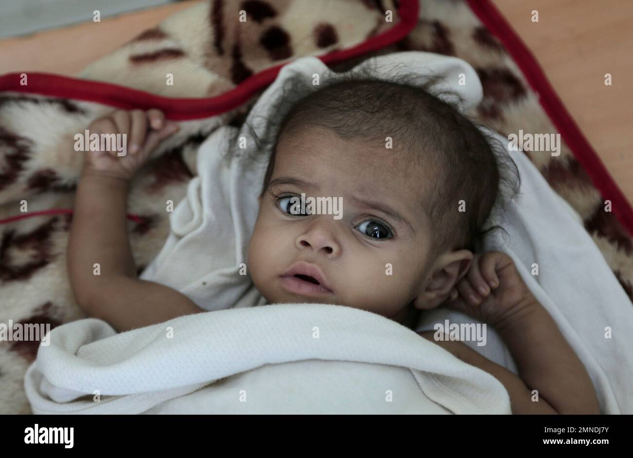 In this Feb. 10, 2018 photo, 9-month old malnourished Mira Yssin is ...