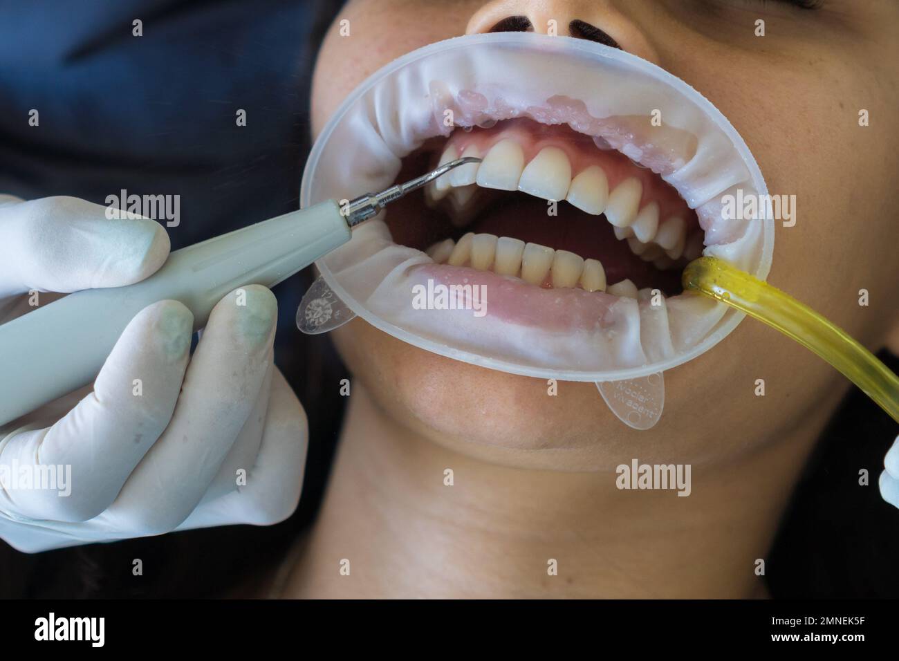 Orthodontic device hygiene hi-res stock photography and images - Alamy