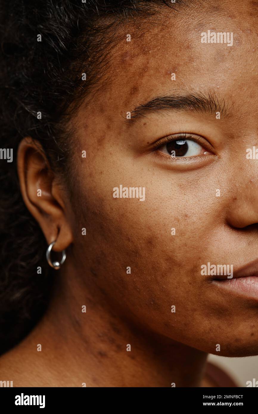 Vertical macro shot of acne scars on face of young black woman looking ...