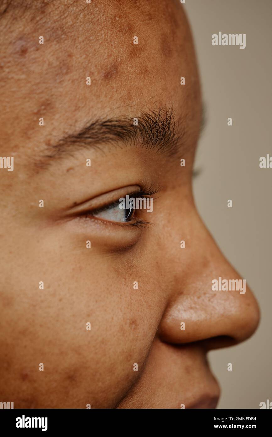Macro shot side view of ethnic young woman with acne scars on face ...