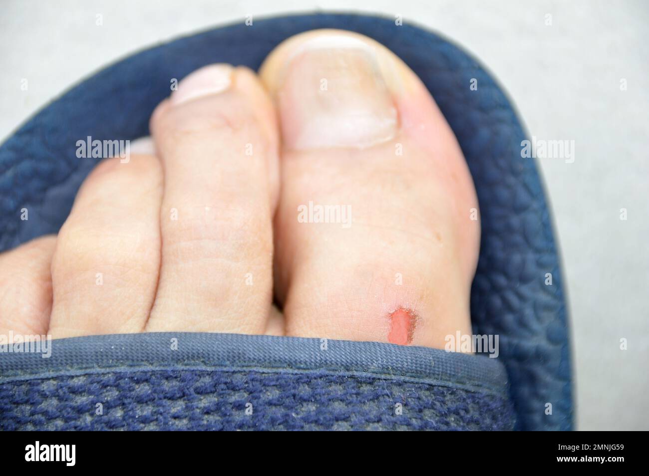wound on a toe by the shoe rubbing of a rubber shoe Stock Photo - Alamy