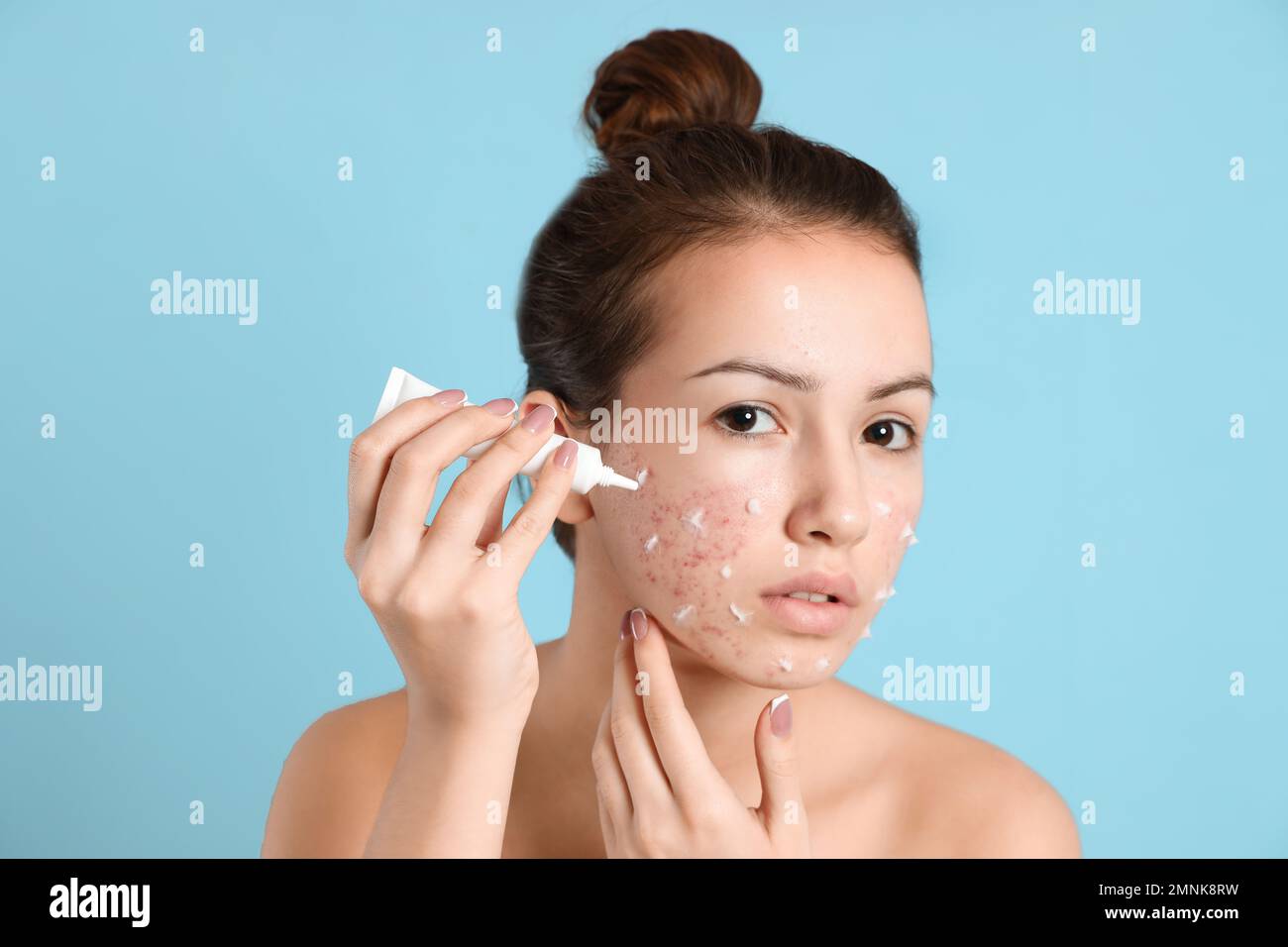 Teen girl with acne problem applying cream on light blue background ...