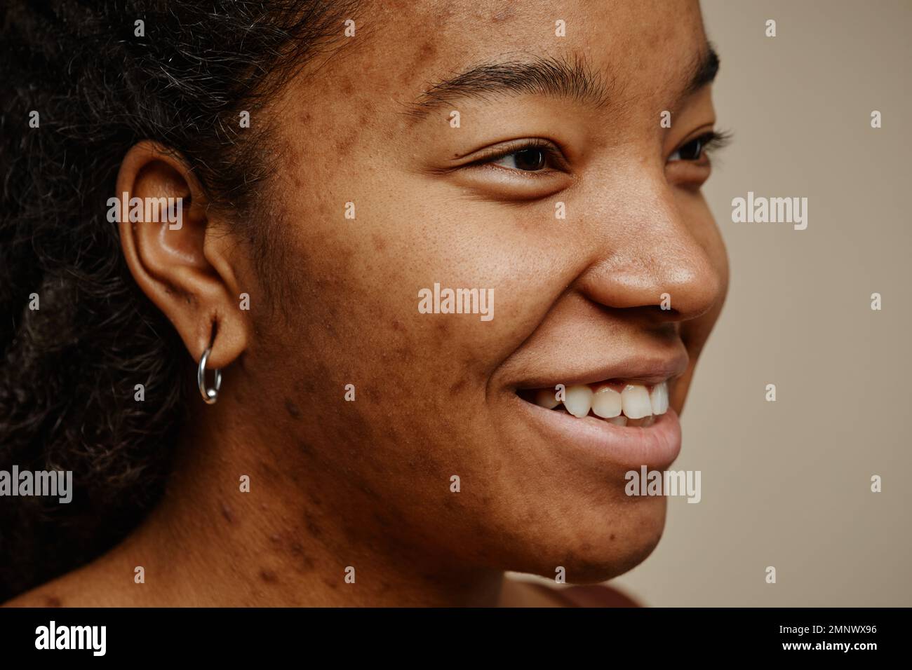 Close up portrait of ethnic young woman with acne scars on face smiling ...