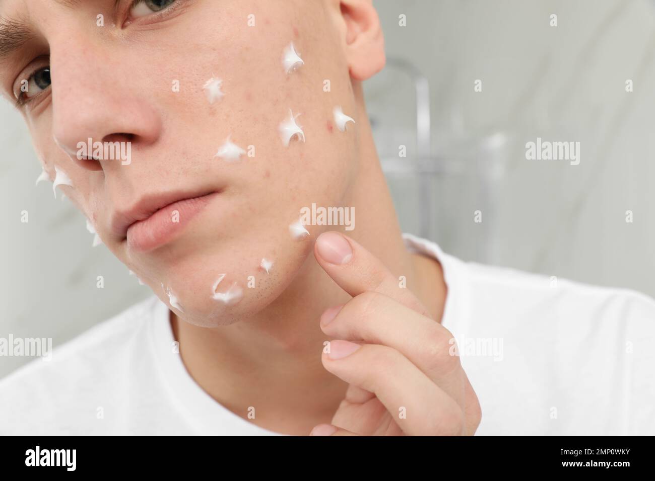 Teen guy with acne problem applying cream indoors, closeup Stock Photo ...