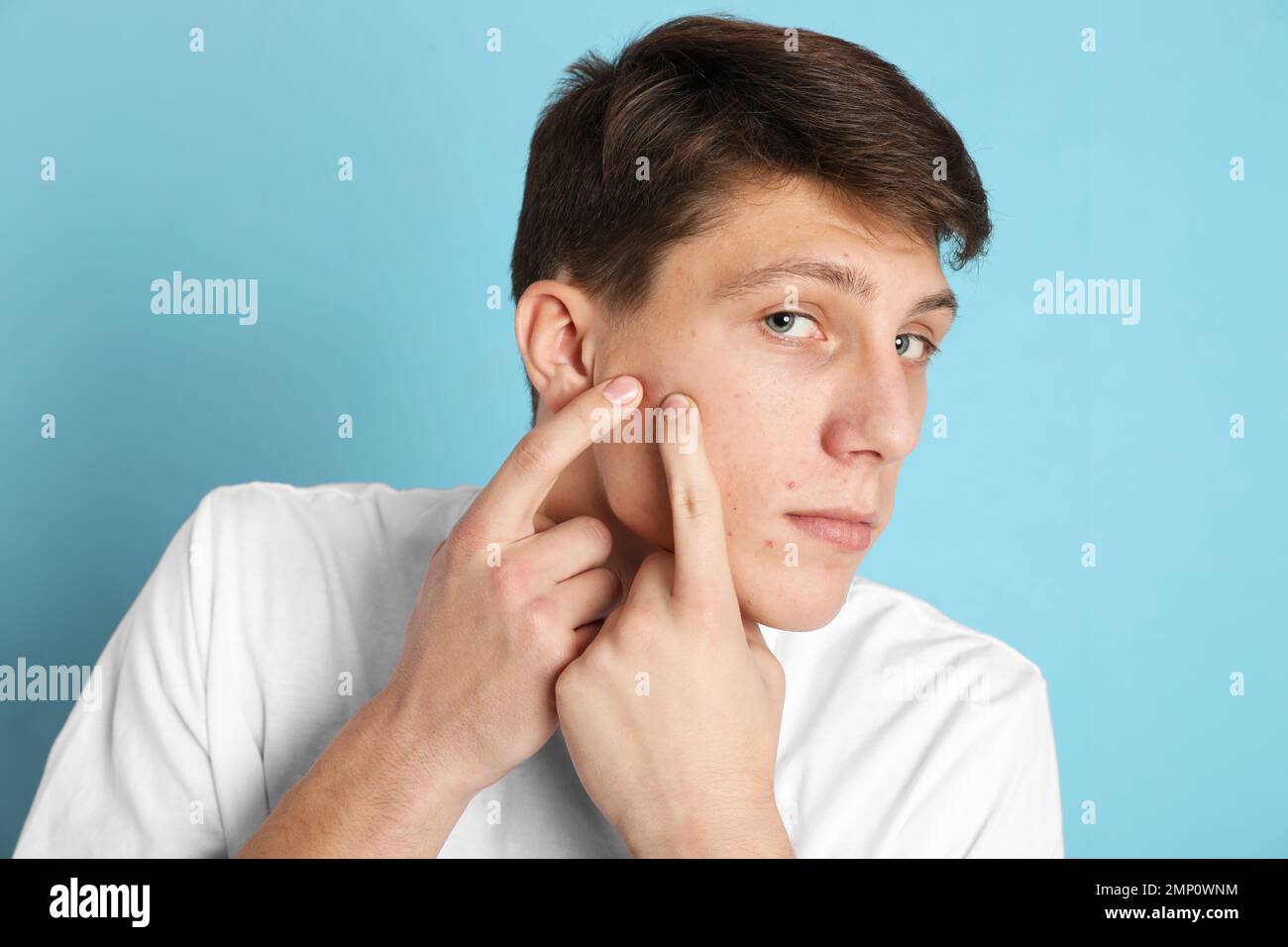 Teen guy with acne problem squeezing pimple on light blue background ...