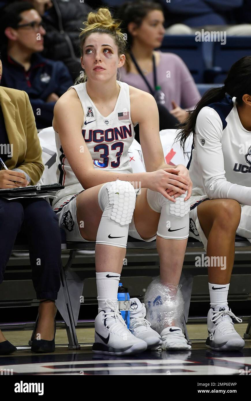 Connecticut's Katie Lou Samuelson sits on the bench with a black eye ...