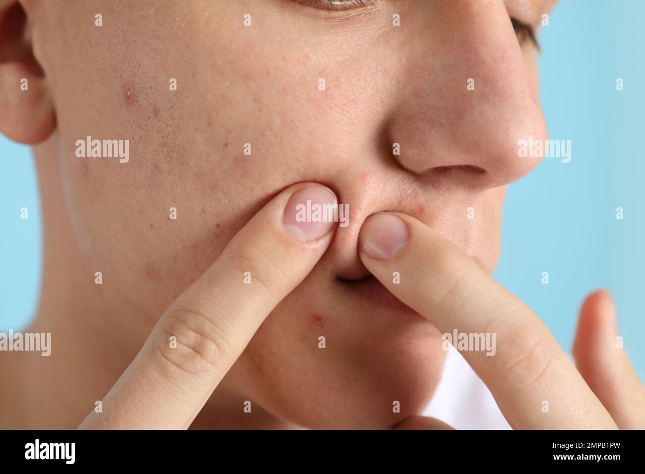 Teen guy with acne problem squeezing pimple on light blue background ...