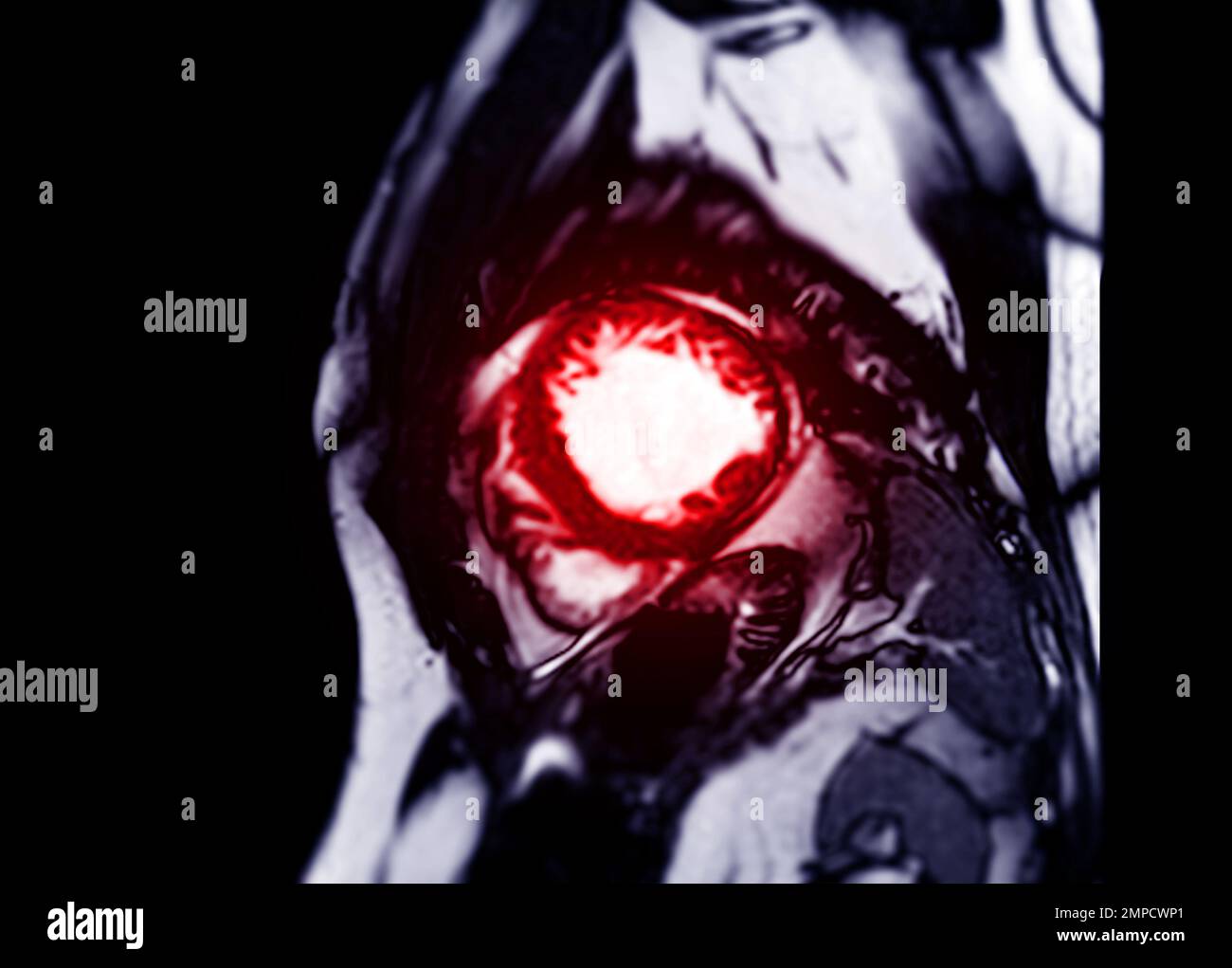 MRI heart or Cardiac MRI in short axis view showing cross-sections of ...