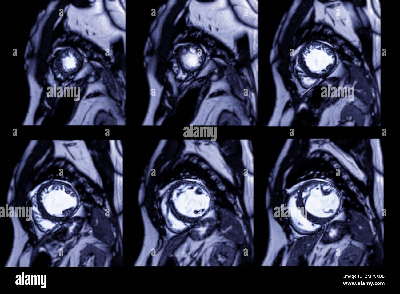Mri Heart Or Cardiac Mri In Short Axis View Showing Cross Sections Of The Left And Right
