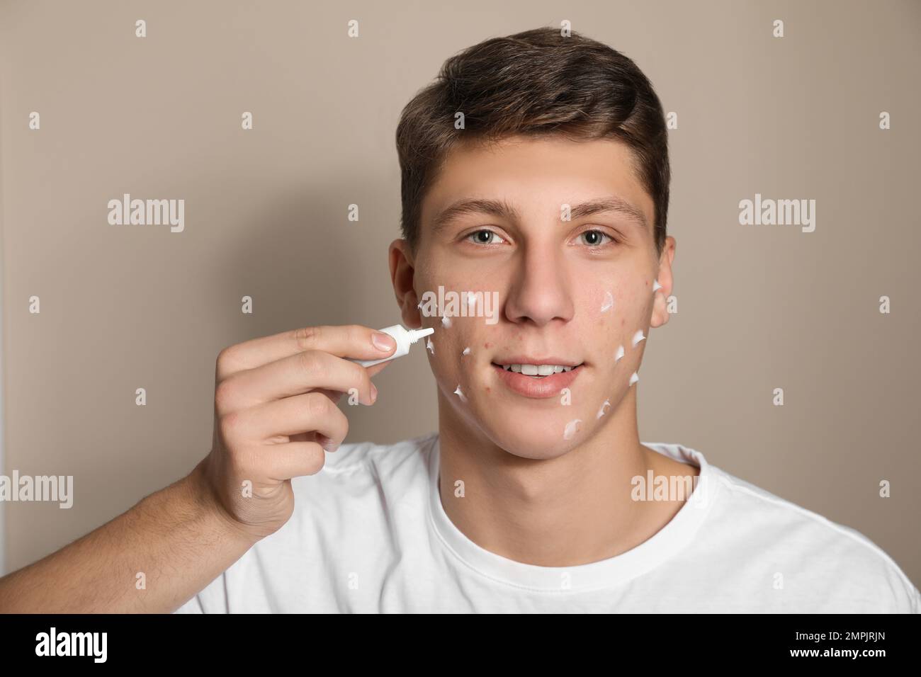Teen guy with acne problem applying cream on beige background Stock ...