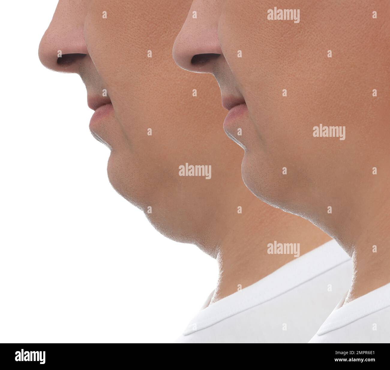 Mature man before and after plastic surgery operation on white ...