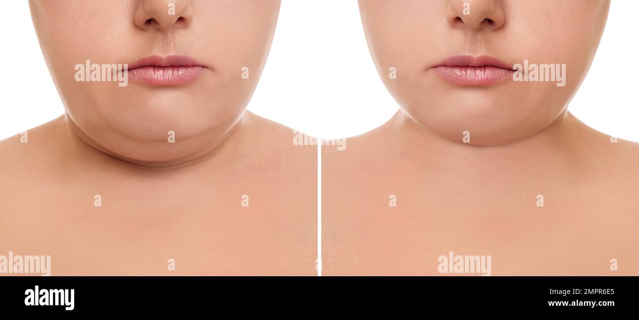 Woman before and after plastic surgery operation on white background ...