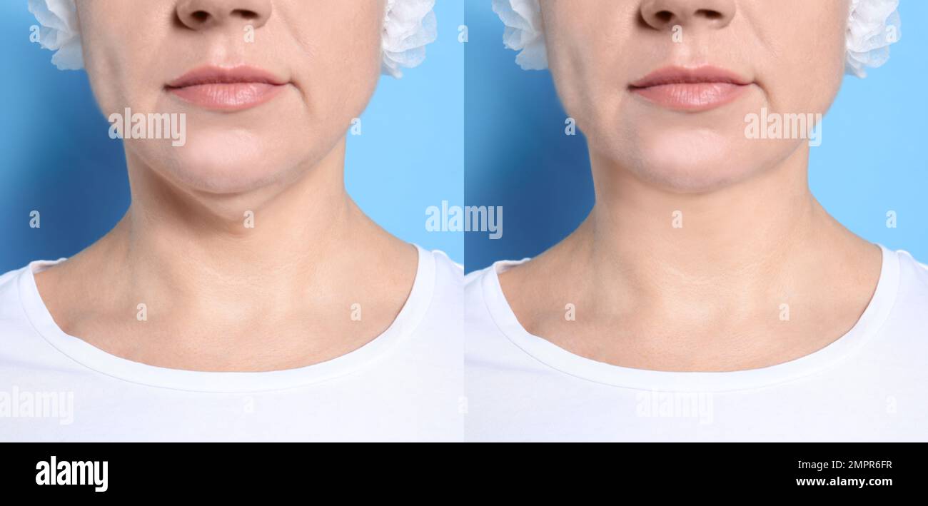Mature woman before and after plastic surgery operation on blue ...