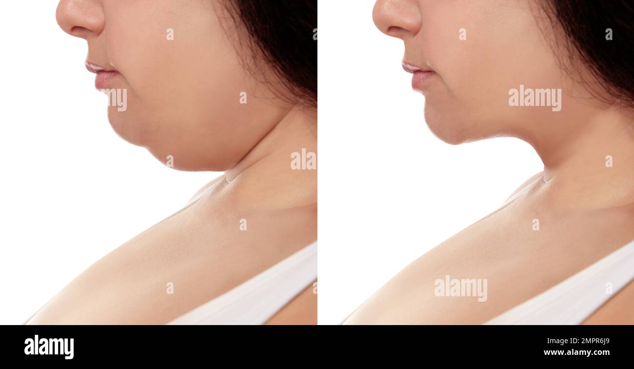 Woman before and after plastic surgery operation on white background ...