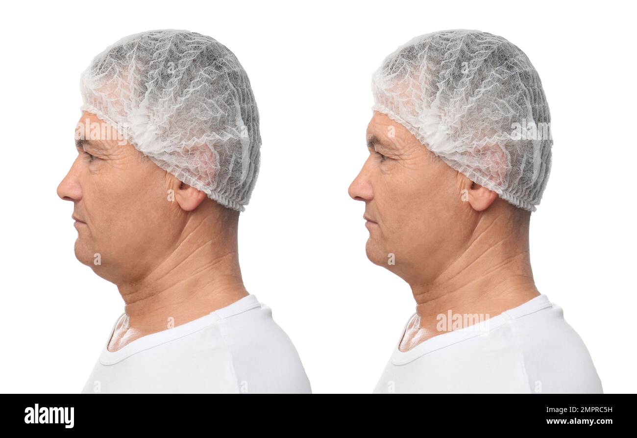 Mature man before and after plastic surgery operation on white ...