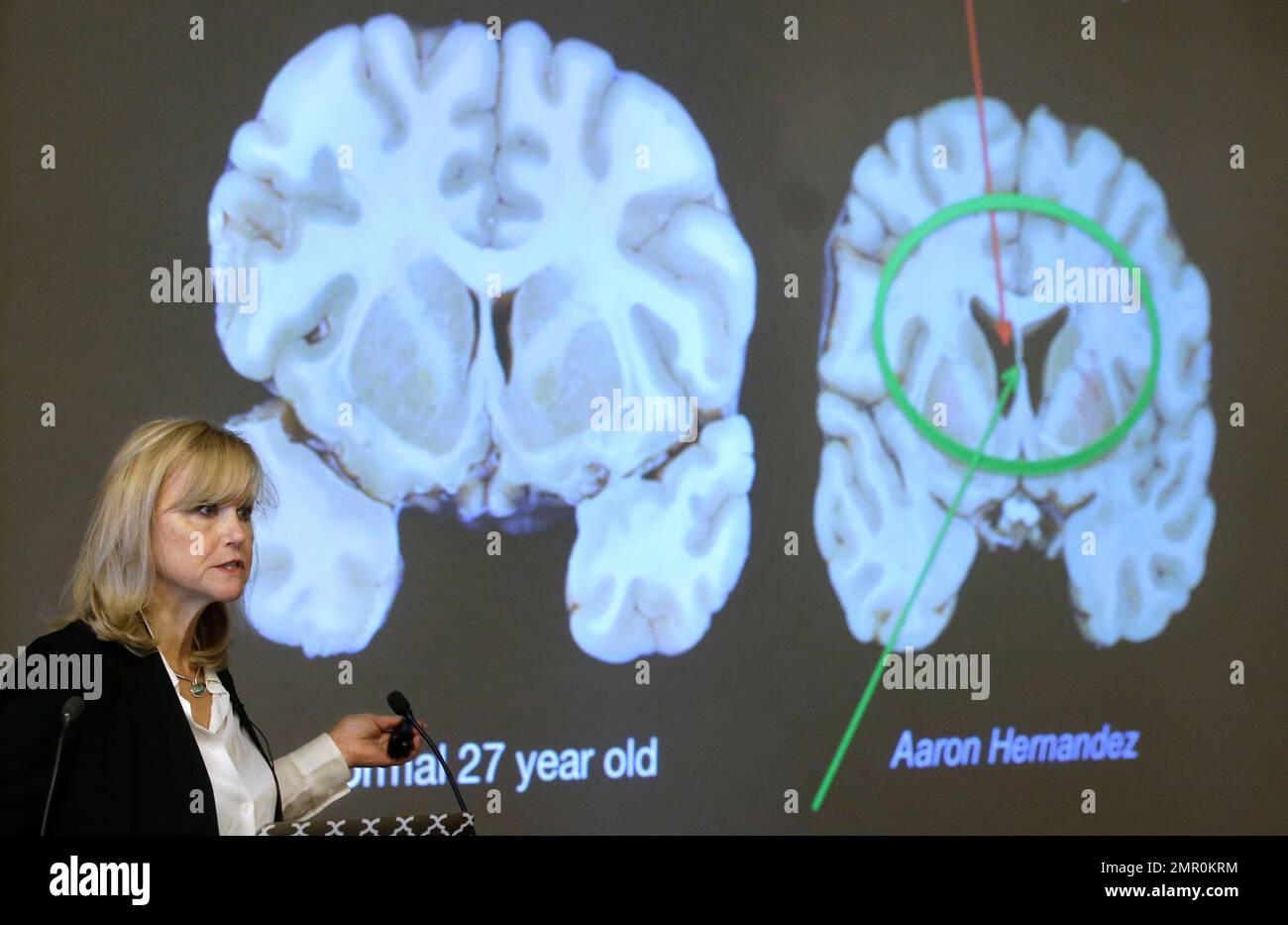 Ann McKee, director Boston University's center for research into the ...