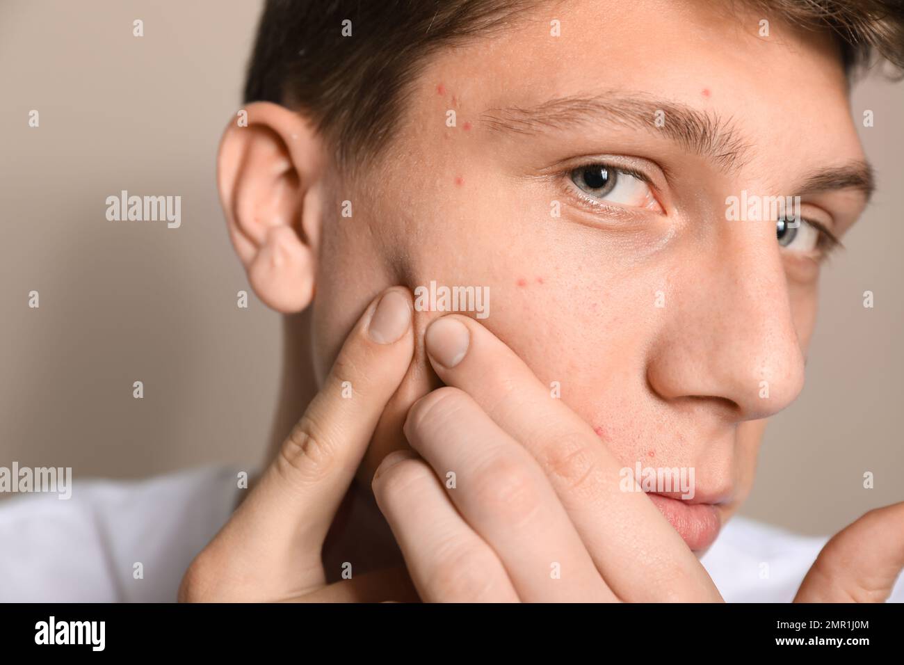Teen guy with acne problem squeezing pimple on beige background ...