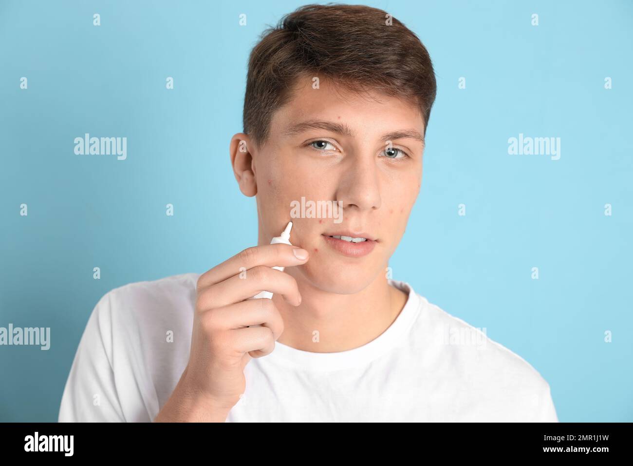 Teen guy with acne problem applying cream on light blue background ...