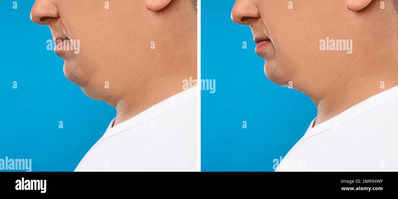 Mature man before and after plastic surgery operation on blue ...