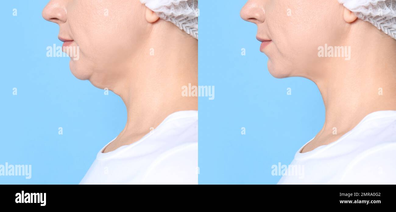 Mature woman before and after plastic surgery operation on blue ...