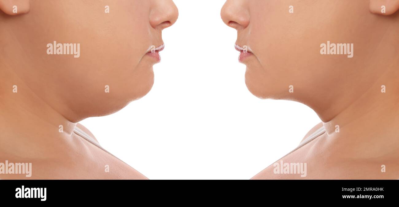 Woman before and after plastic surgery operation on white background ...