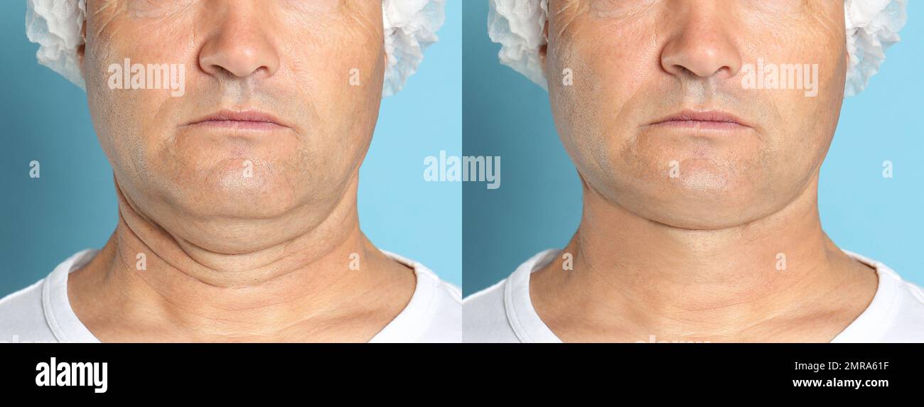 Mature man before and after plastic surgery operation on blue ...