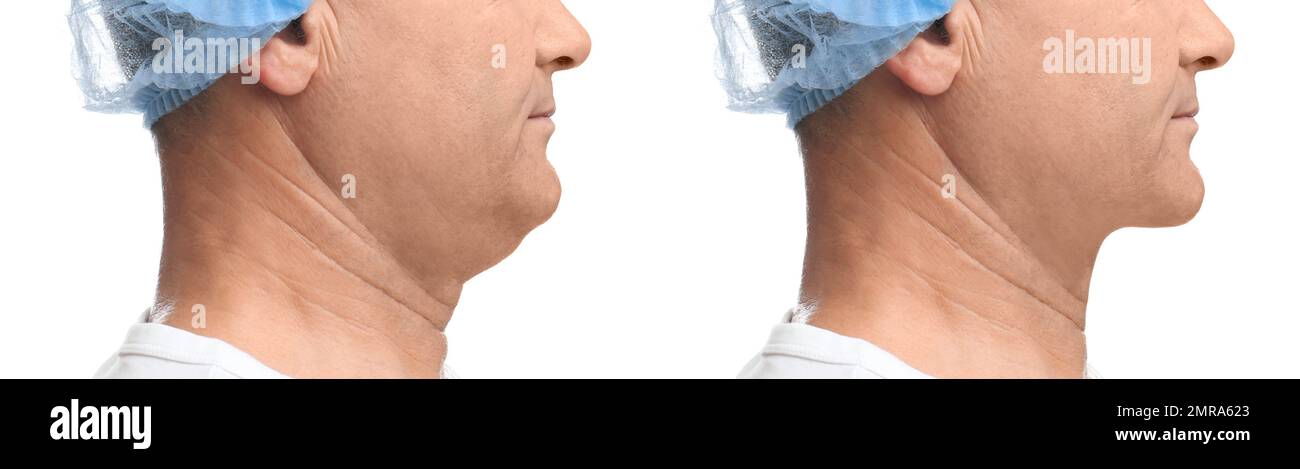 Mature man before and after plastic surgery operation on white ...