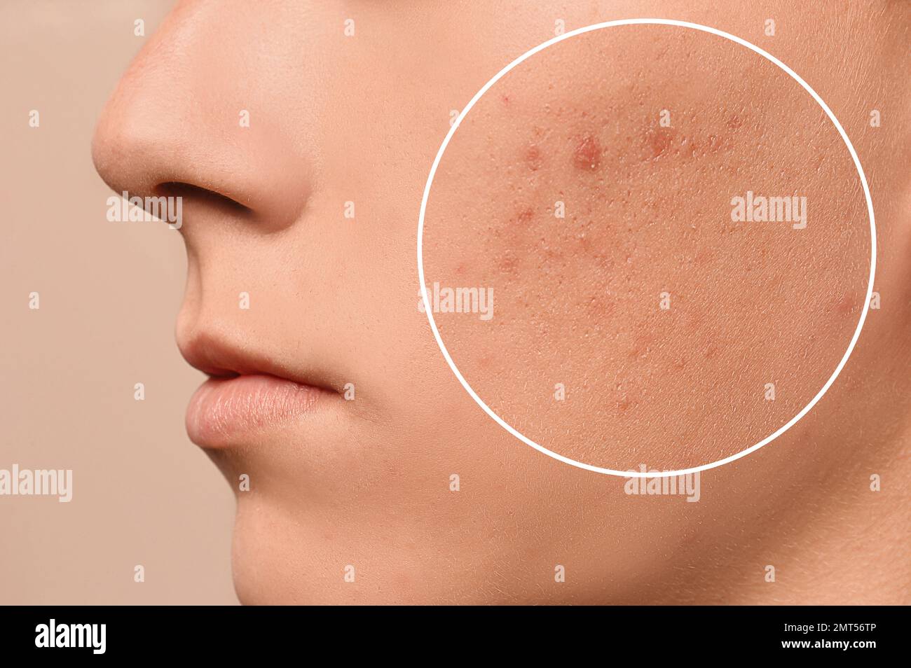 Teenage boy with acne problem on beige background, closeup Stock Photo ...