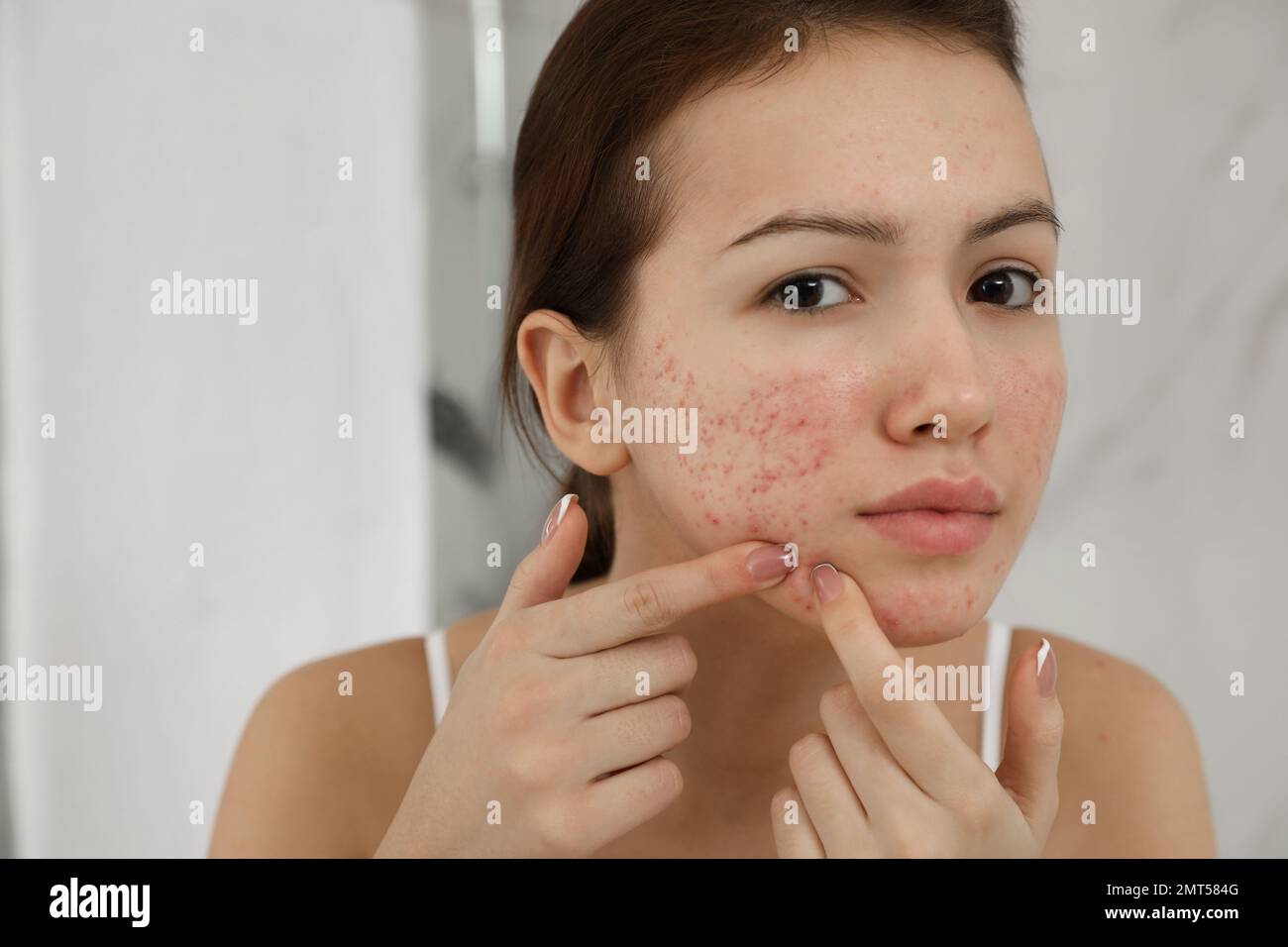 Teen girl with acne problem squeezing pimple indoors Stock Photo - Alamy