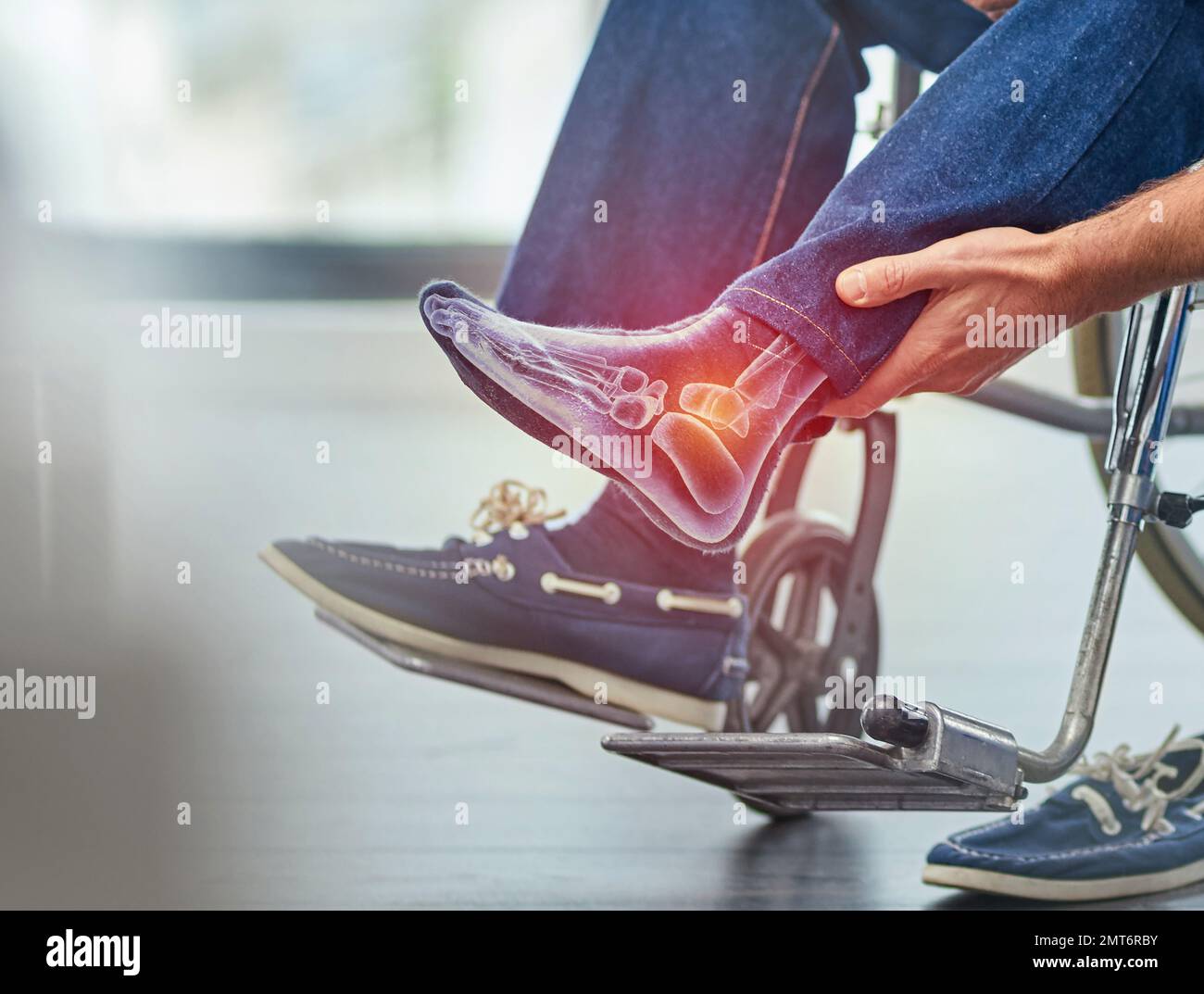 Closeup, man in wheelchair and foot injury with pain, inflammation and ...