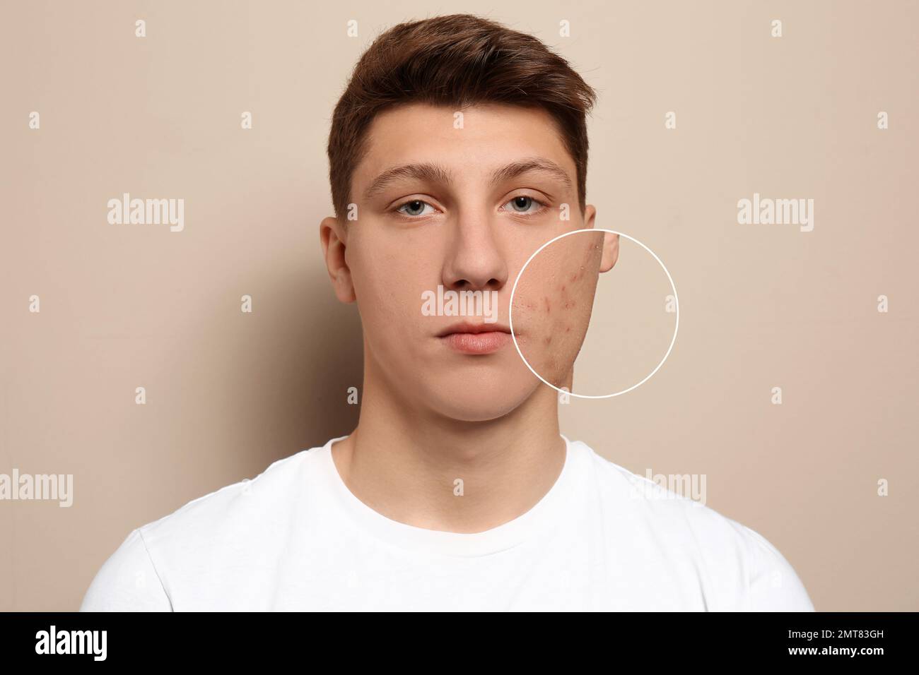 Teenage boy with acne problem on beige background Stock Photo - Alamy