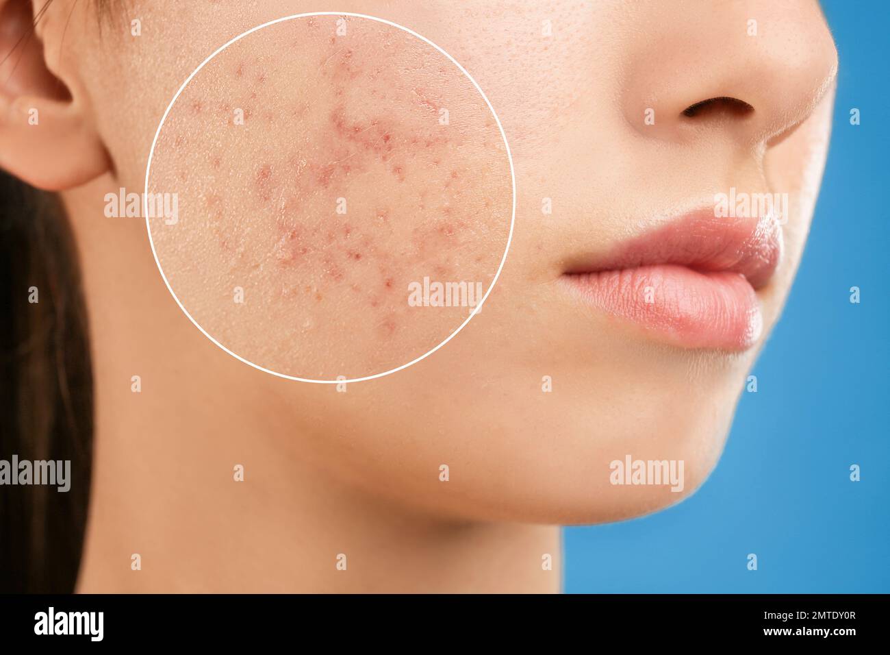 Teenage girl with acne problem on blue background, closeup Stock Photo ...