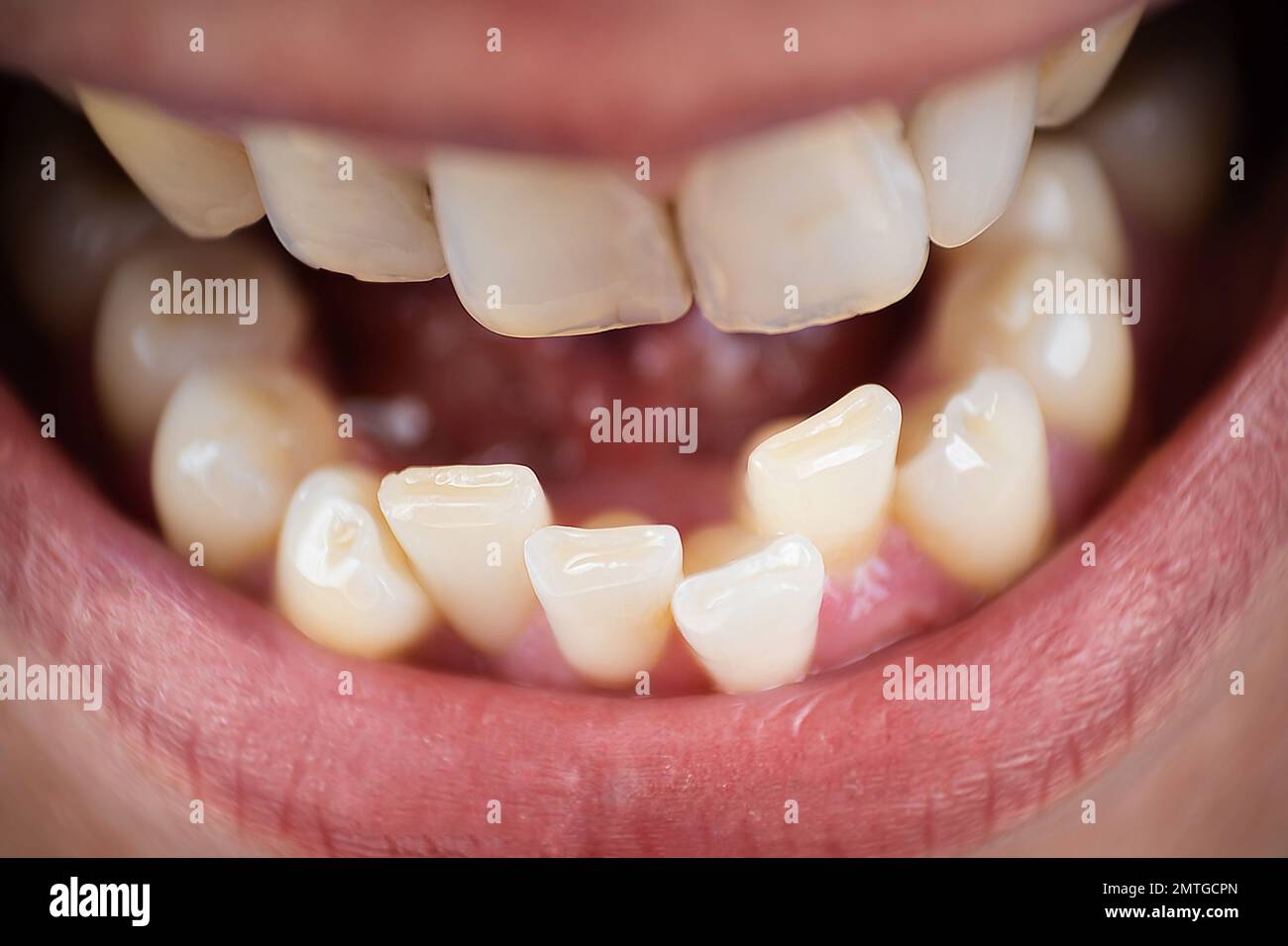 European male open mouth crooked teeth Stock Photo - Alamy