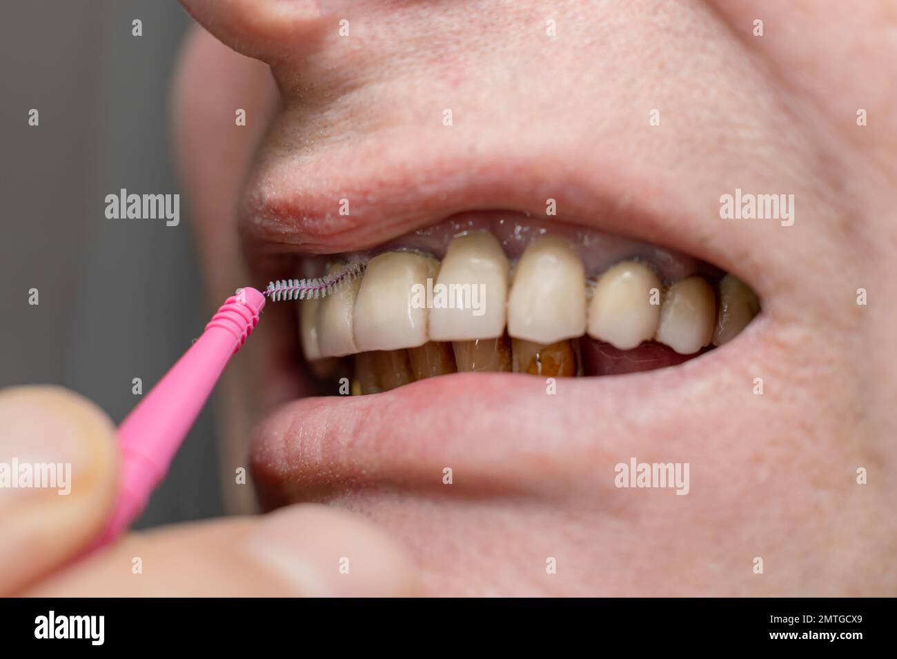 Clean gaps in teeth with a tiny brush - interdental cleaning Stock Photo - Alamy