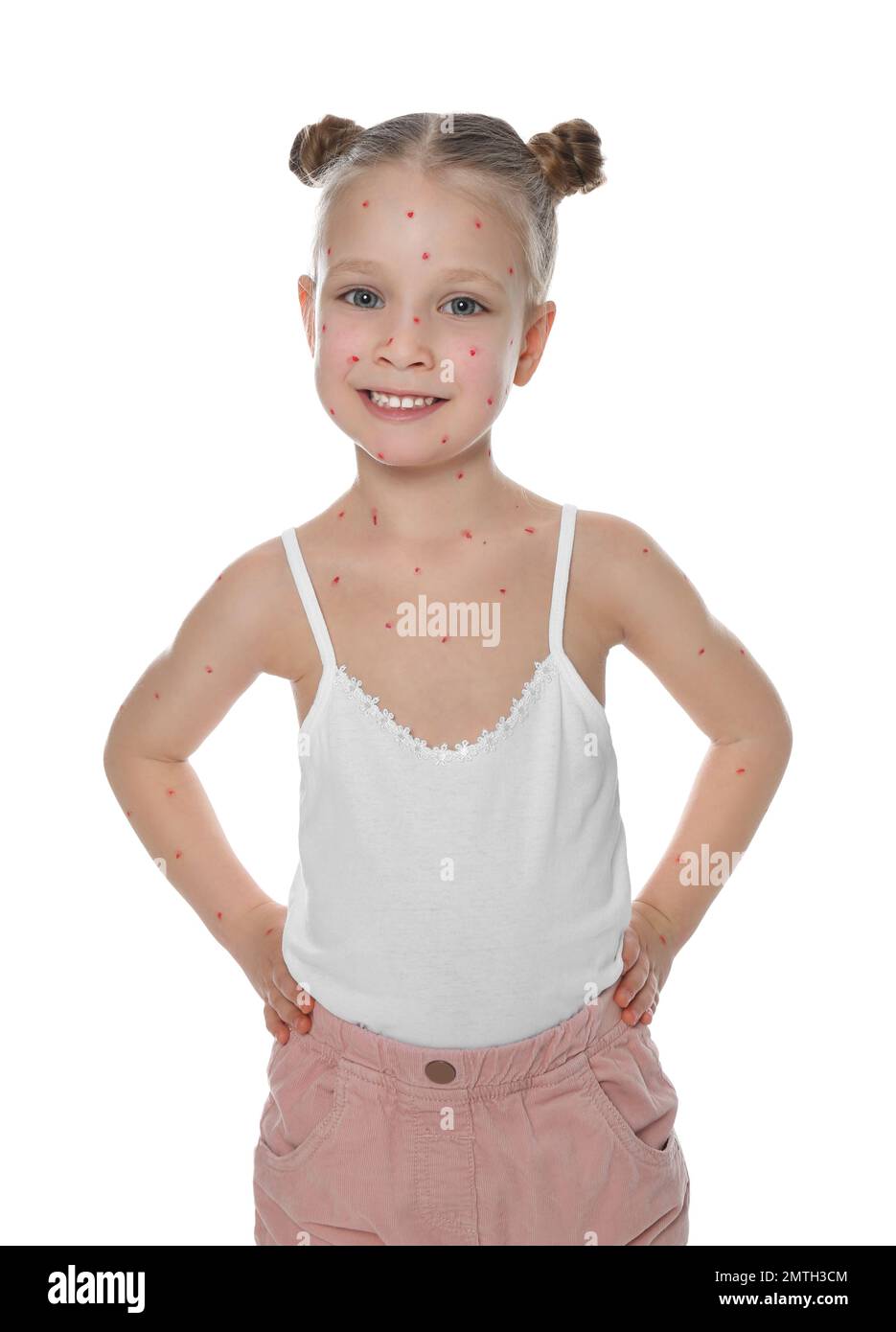Little girl with chickenpox on white background. Varicella zoster virus ...