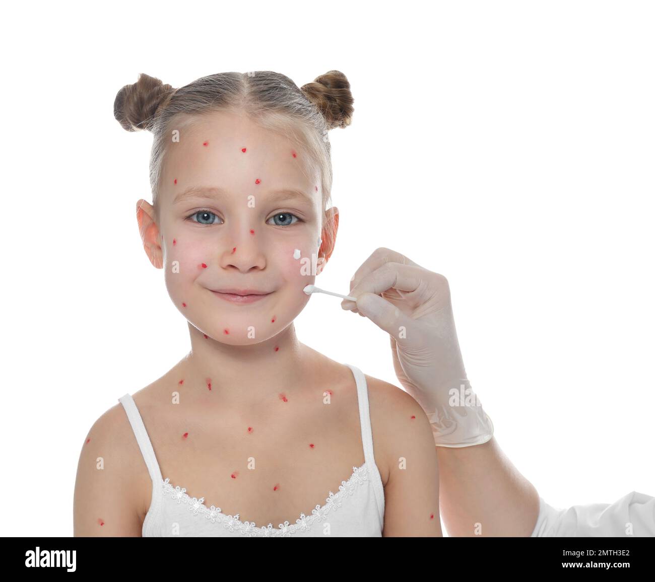 Doctor applying cream onto skin of little girl with chickenpox against ...