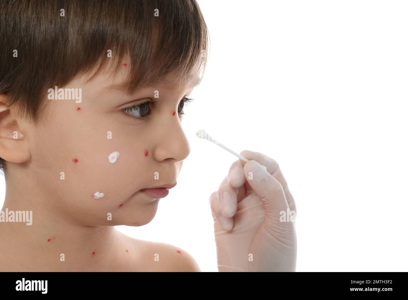 Doctor applying cream onto skin of little boy with chickenpox against ...